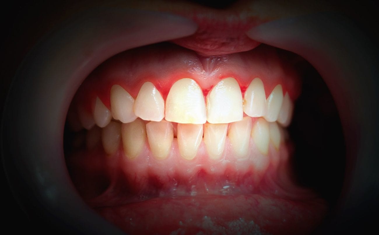 Stress and Your Oral Health | Dentist in Boise, Idaho